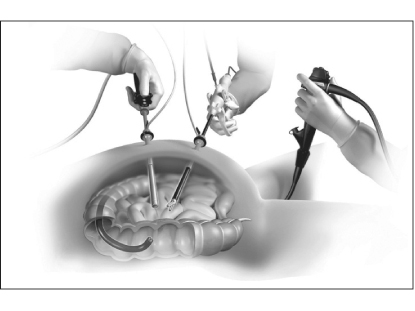 Best surgeon for Laparoscopic Colorectal Surgery in Delhi - Dr. Ashish Goel